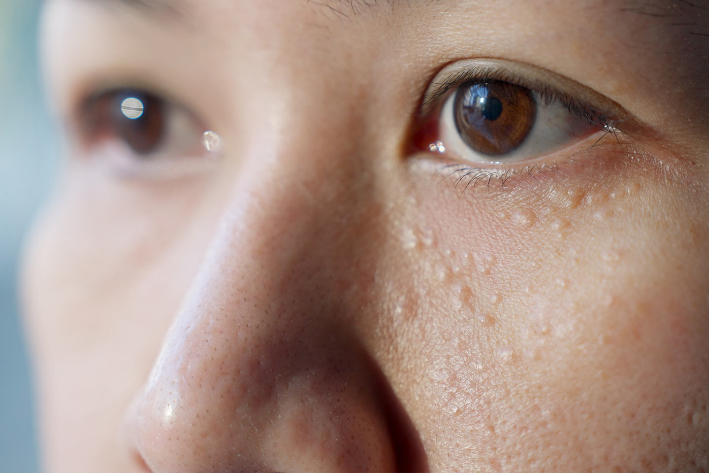 Skin Tags, Moles & Benign Growth | Grace Dermatology & Aesthetics