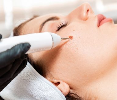 Superficial Growth Removal | Cryotherapy & Electrodessication